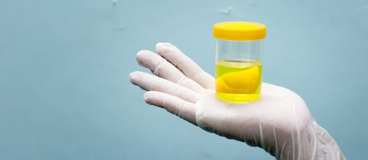 Entenda o exame de urocultura – Don Saúde